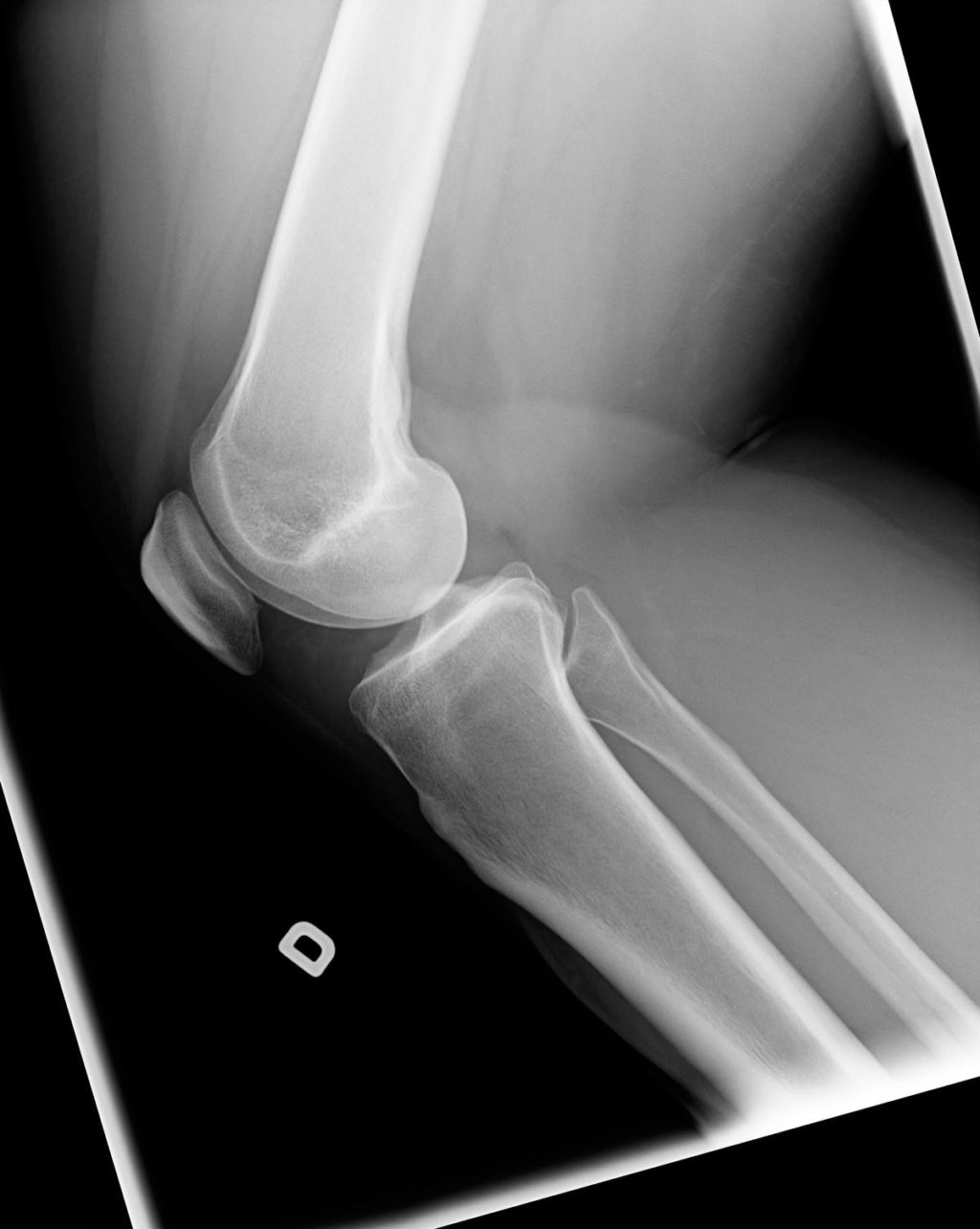 Chondropathie arthrose du genou symptômes et traitements